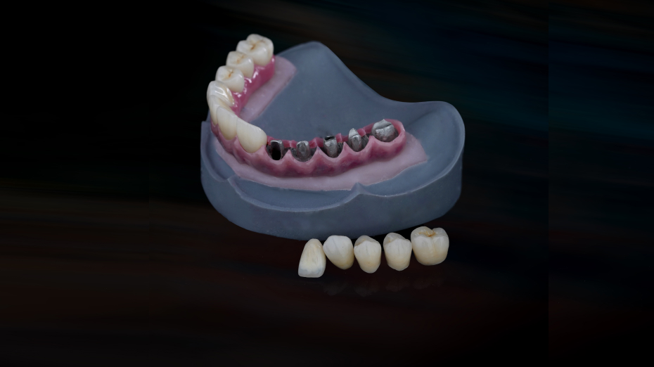 DentCare Implant DMLS Framework To Receive Crown and Bridge (Malo Concept)