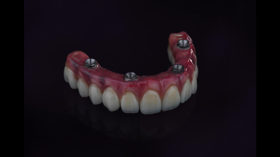 DentCare NOVA Hybrid Denture | PEEK & Titanium Hybrid Denture